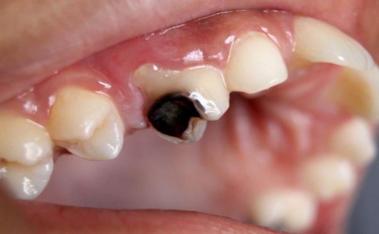 Cavities on the Sides of Your Teeth