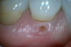 What If You Have Holes in Your Gums?