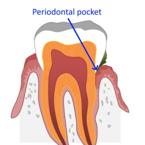 What Is Pyria? How Can It Be treated?