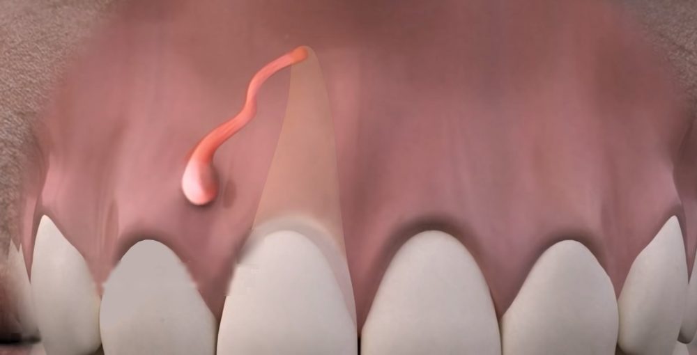 What to do about a fistula on the gums?