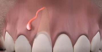What to do about a fistula on the gums?