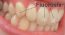 All About White Lines on Teeth (Fluorosis And Craze Lines)