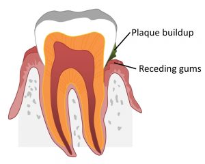 dental-plaque-causing-pockets-and-receding-gums | Kuipers Ortho